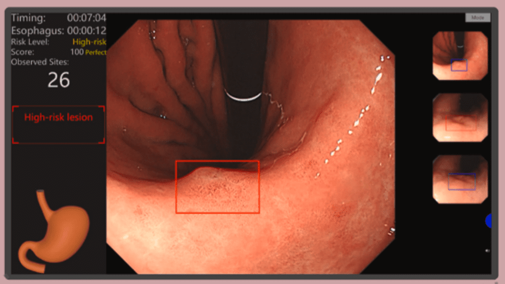 AI-Assisted Endoscopy: Can AI Change Gastric Cancer Detection ...